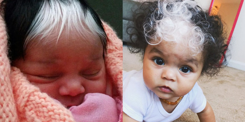 This Baby Was Born with Mysterious Hair and Skin But Here is How She ...