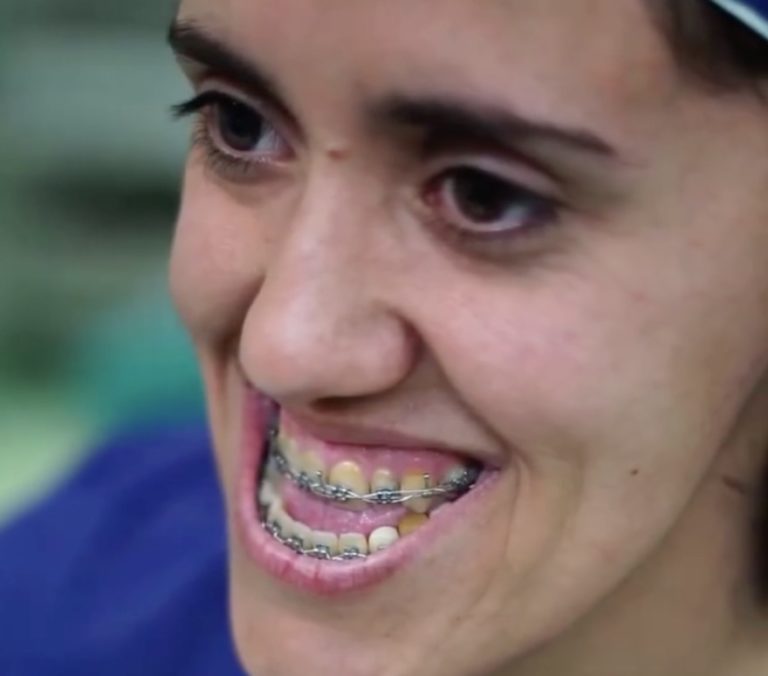 She Hated Her Jaw for Years But What She Looks Like After Surgery Will ...