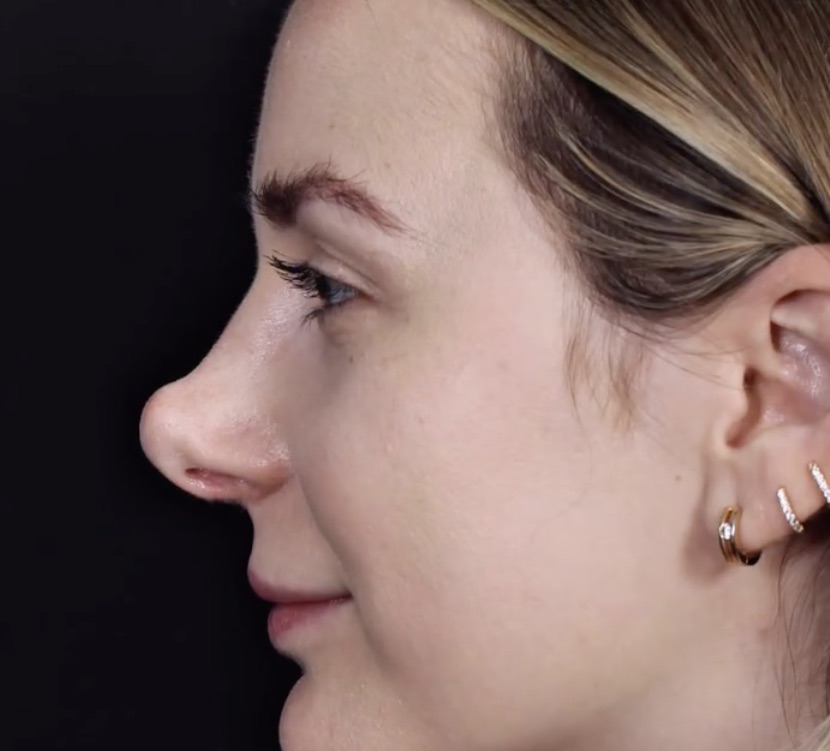 This Woman Had a Weird Nose Before But Looks Like a Totally New Person ...